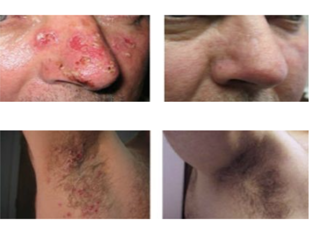 Services - Center For Blistering Diseases
